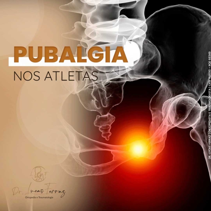 Pubalgia nos atletas - Dr. Lucas Ferraz